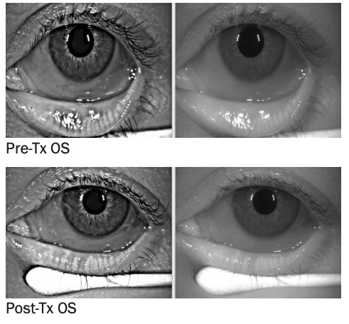Advanced Dry Eye Treatment | InMode Technology | Lasting Relief
